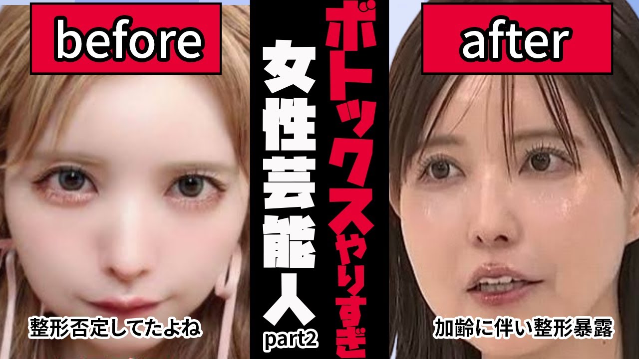 【ガルちゃん芸能】ボトックスやりすぎ女性芸能人part2【有益2ch】 - MAGMOE